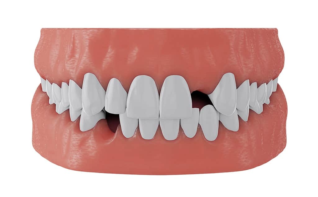 Edentulismo: Causas, Soluciones - midentista Valencia